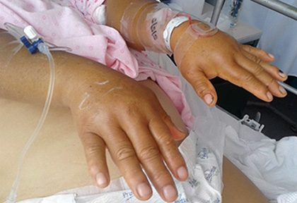 Loxoscelismo cutáneo-visceral en una zona rural con desenlace favorable ...